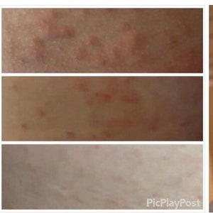 Brown Tail Moth Rash Relief Spray/anti Itch Spray/contact Dermatitis ...