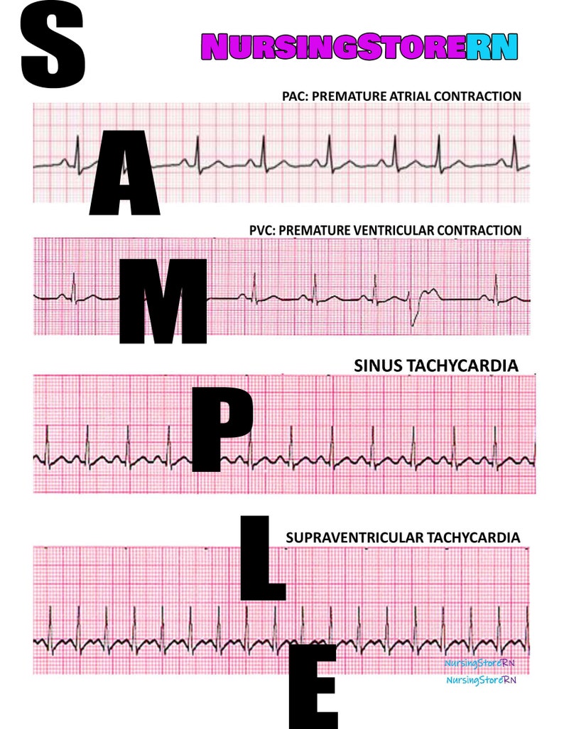 EKG Interpretation & Dysrhythmias Med Surg Nursing Digital - Etsy Canada
