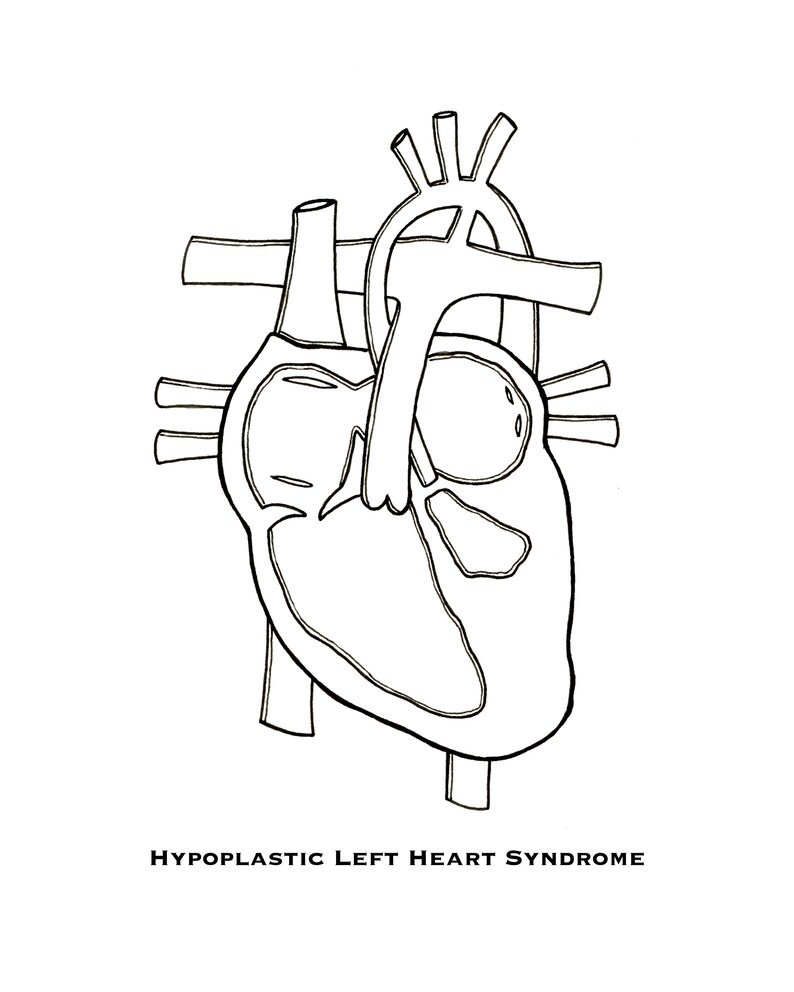 Hypoplastic Left Heart Syndrome - Art Print // Congenital Heart Disease ...