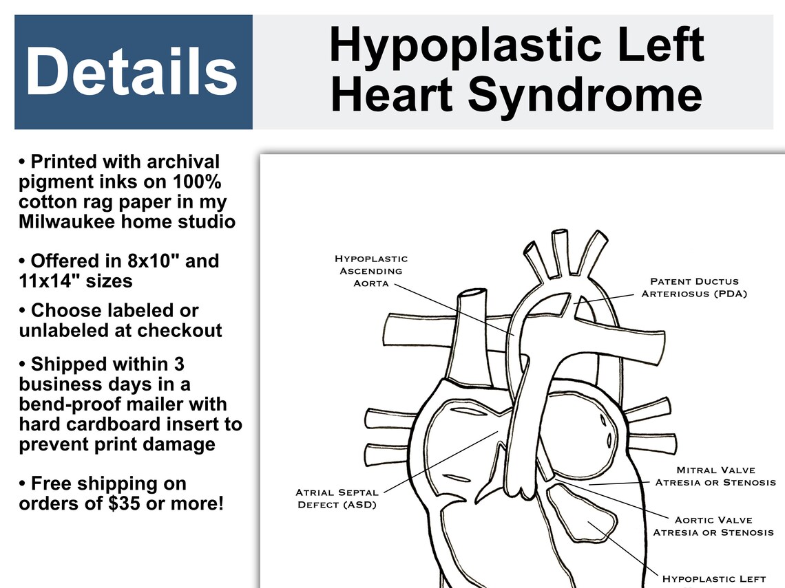Hypoplastic Left Heart Syndrome - Art Print // Congenital Heart Disease ...