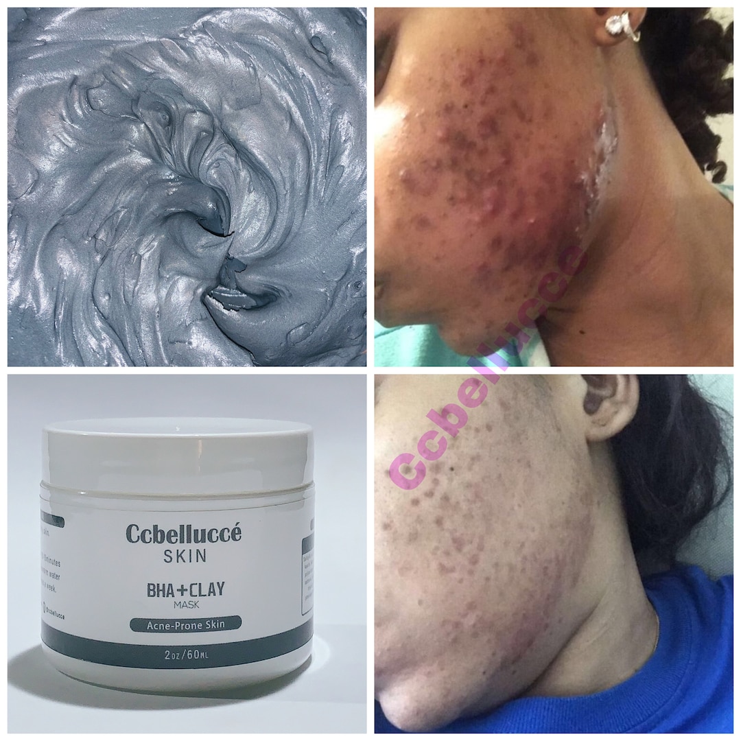 BHA CLAY MASK - Etsy