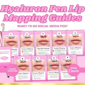 Hyaluron Pen Lip Mapping, Dermal Lip Fillers, Lip Maps, Russian Lips ...