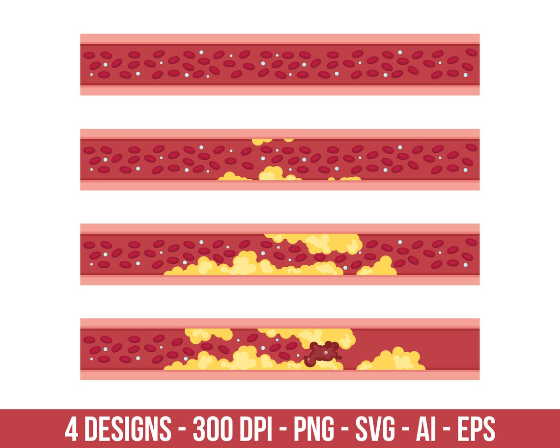Phases of Atherosclerosis Clipart Set. Digital Images or Vector ...