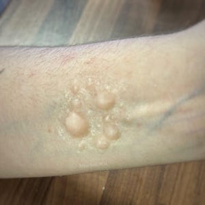 Various Boils / Silicone Prosthetic / Fake Injury / Latex Free ...