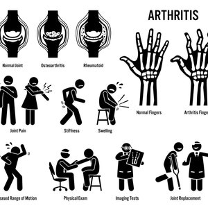 Arthritis Joint Pain Joint Disease Signs Symptoms Diagnosis Treatment ...