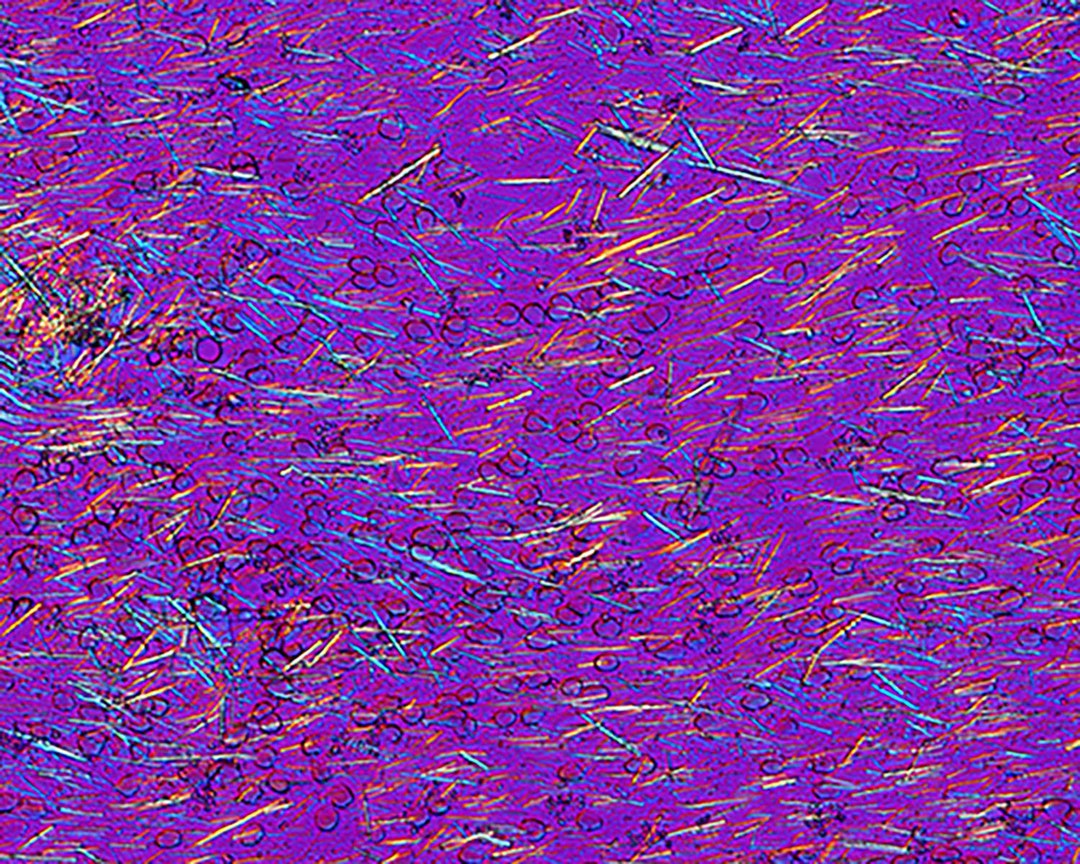 Monosodium Urate (MSU) Crystals - Etsy