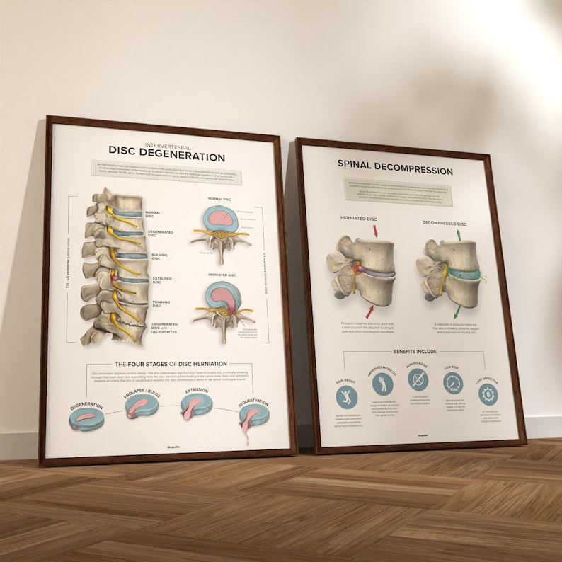 INTERVERTEBRAL DISC DEGENERATION - Etsy