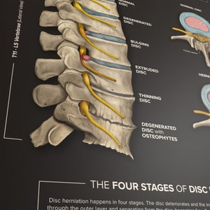 INTERVERTEBRAL DISC DEGENERATION - Etsy
