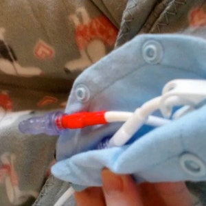 5 NGT Enteral Feeding Tube Connection Port IV Peg J-tube JEJ Hickman ...