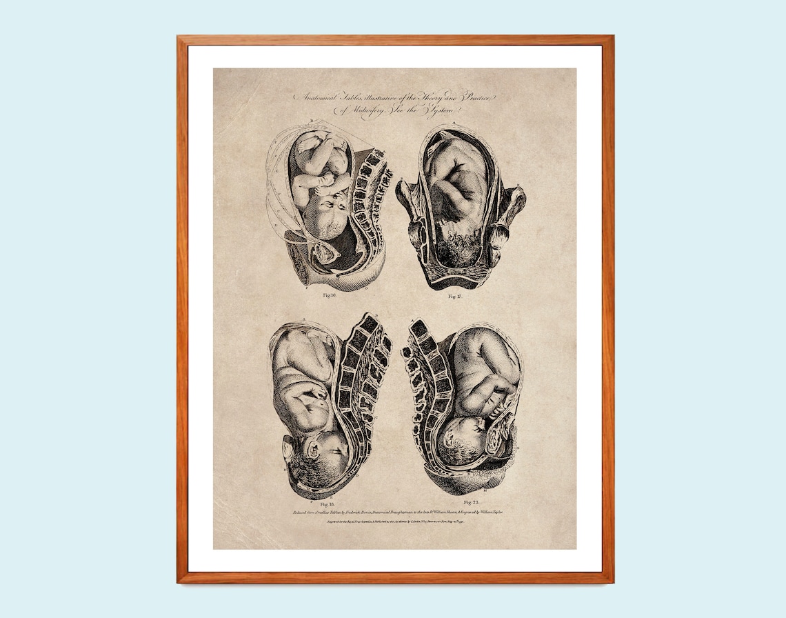 Infant Fetal Positions Poster Vintage Female Anatomy Art | Etsy