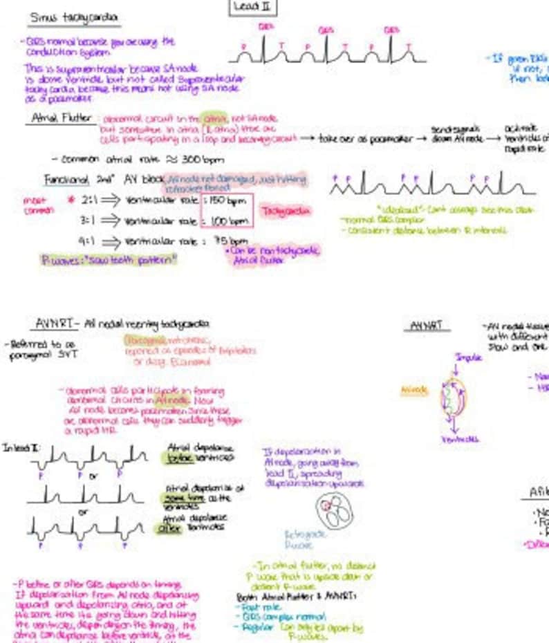 Arrhythmias, ECG Wave Morphologies, Coronary Syndromes, Atrial ...