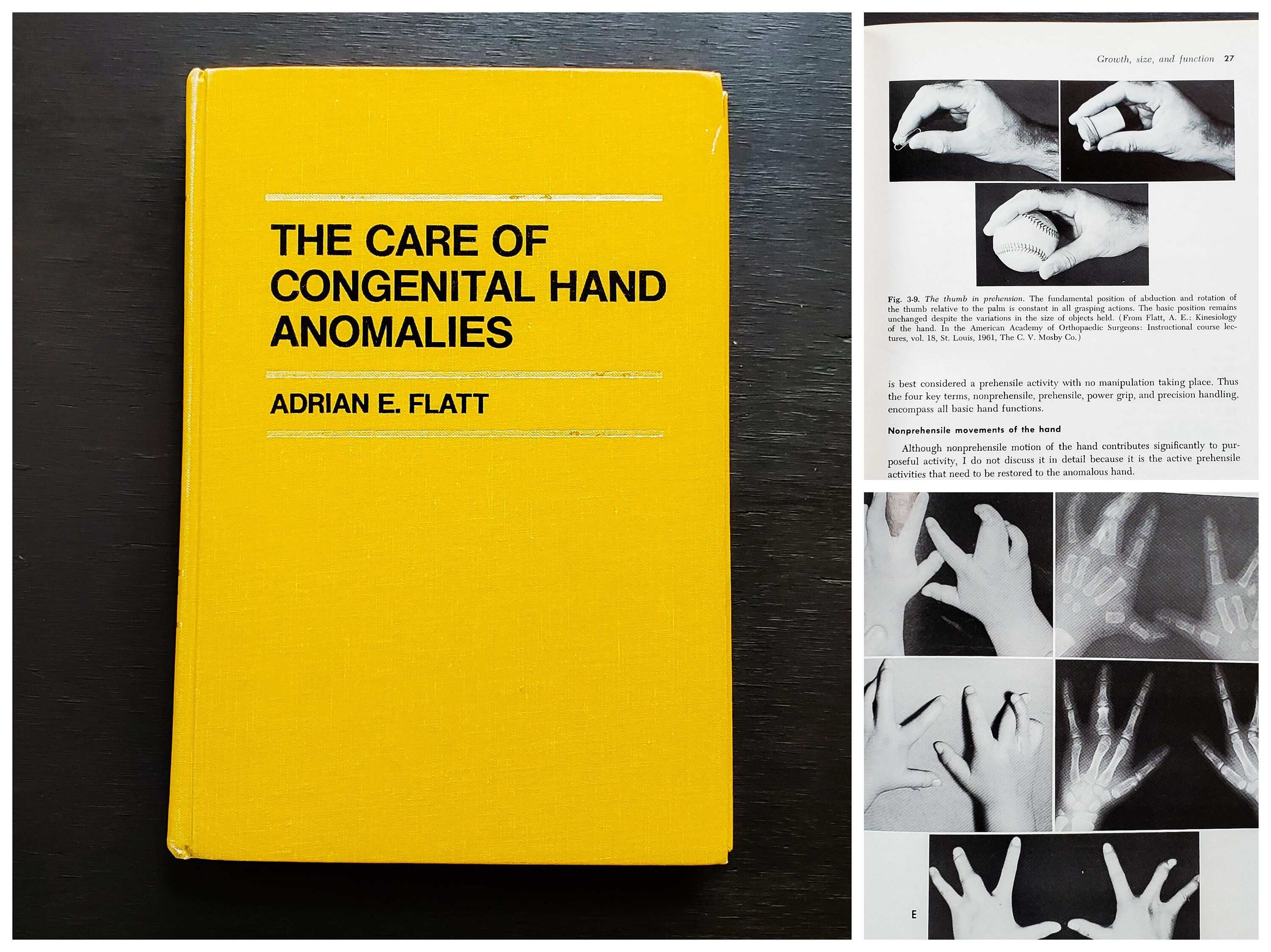 Rare Vintage 1st Ed 1977 the Care of Congenital Hand Anomalies by ...
