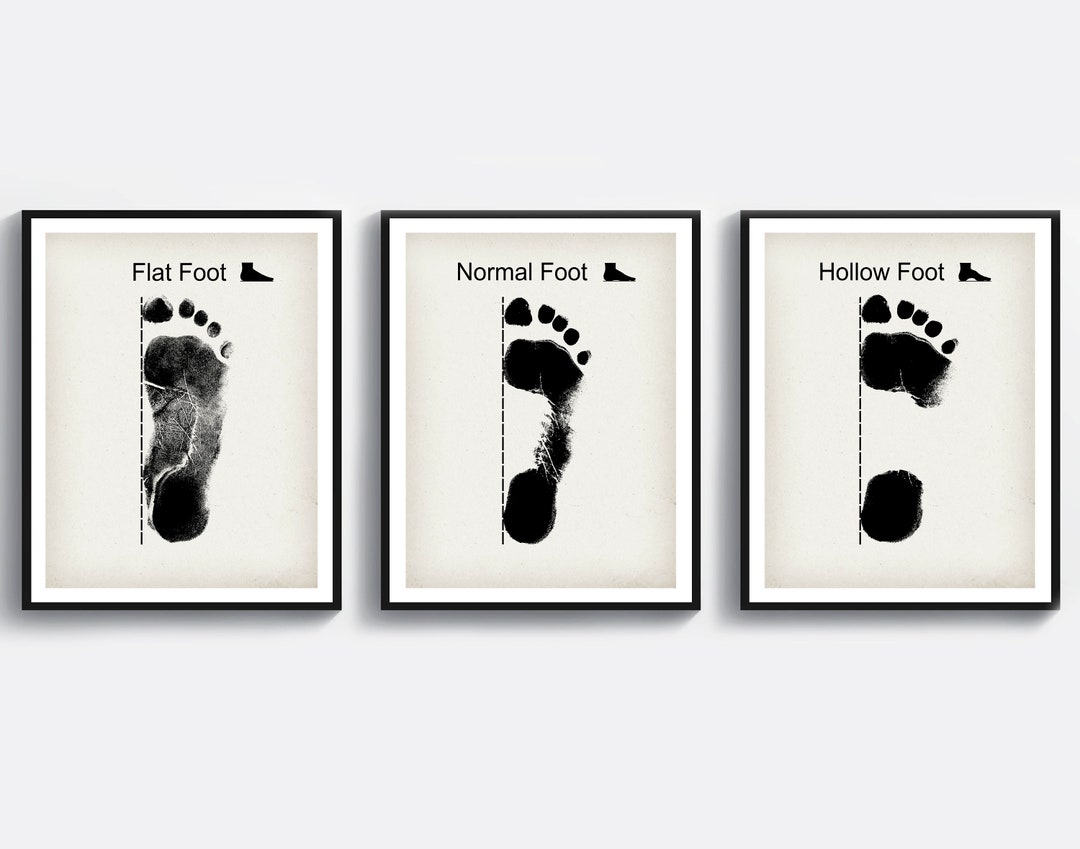 3 Footprint Art, Medical Art, Orthopedist Gift, Foot Pathology ...