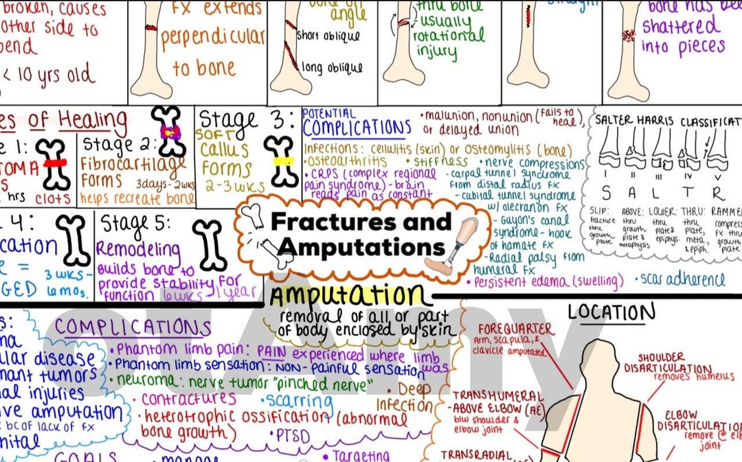 Fractures & Amputations One-page Outline / Concept Map (2-in-1) - Etsy