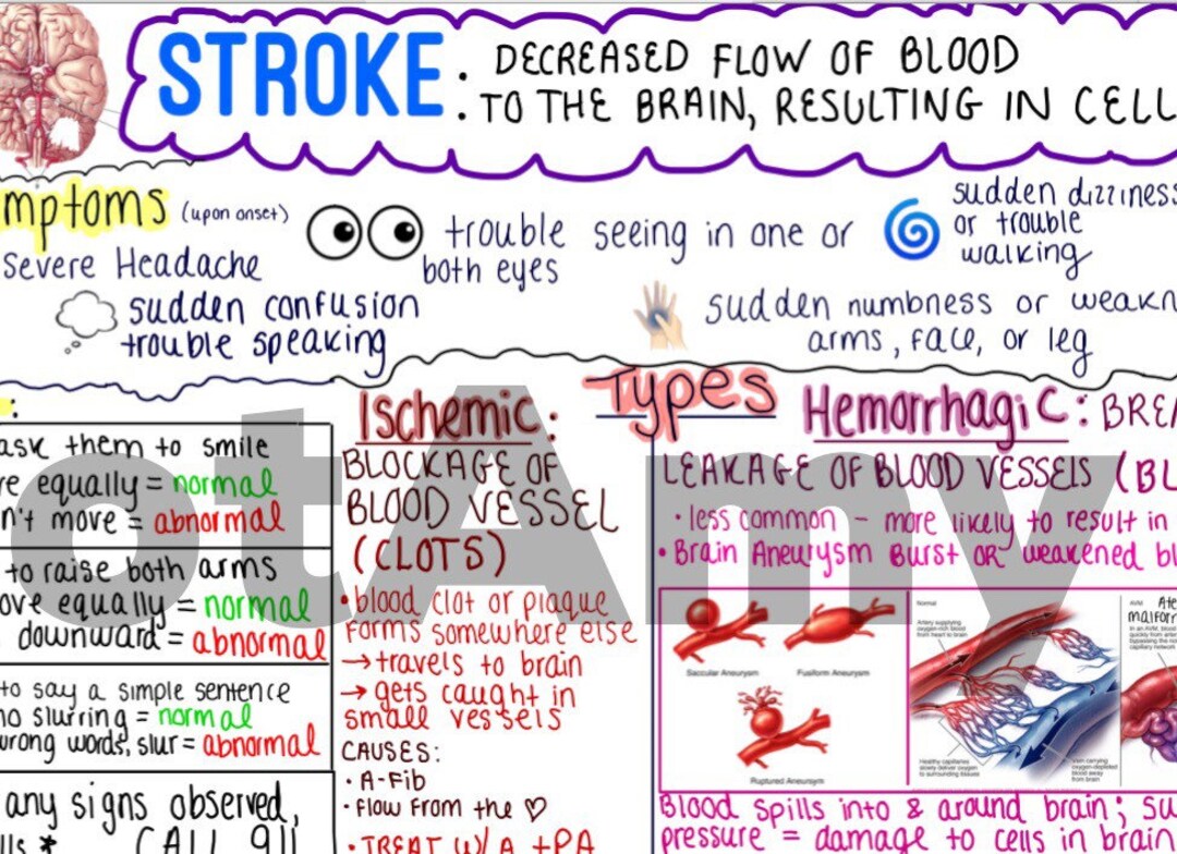 Stroke One-page Outline / Concept Map - Etsy