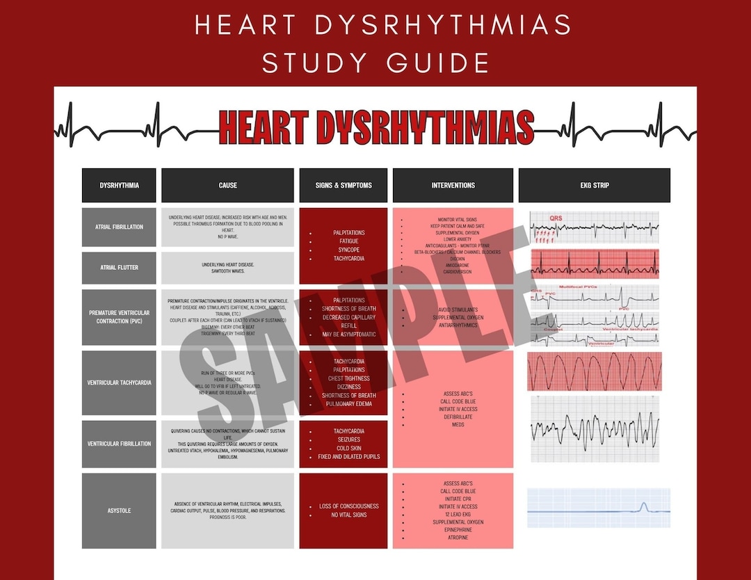 Nursing Student Heart Dysrhythmias Study Guide Notes Nursing School ...