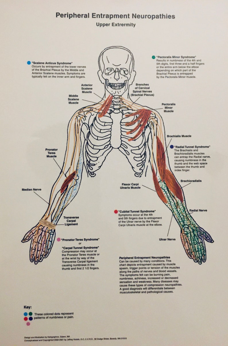 Peripheral Entrapment Neurapathy Poster Set - Etsy