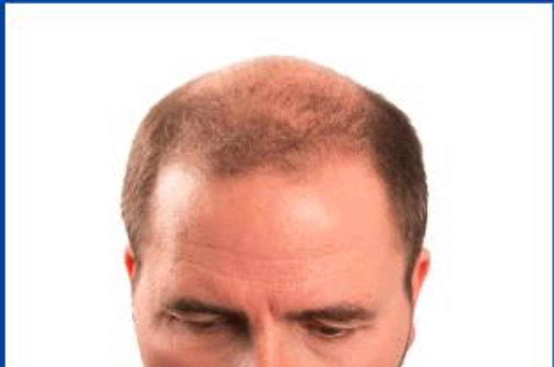 Grow It Back - the Bold Natural Method to Regain Your Hair and ...
