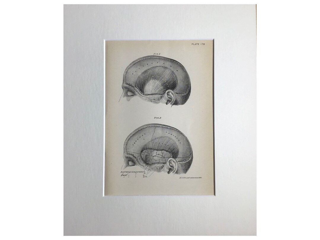 Anatomy Print, 1888 NYC, Autopsy Print, Antique Print, Dissection Print ...
