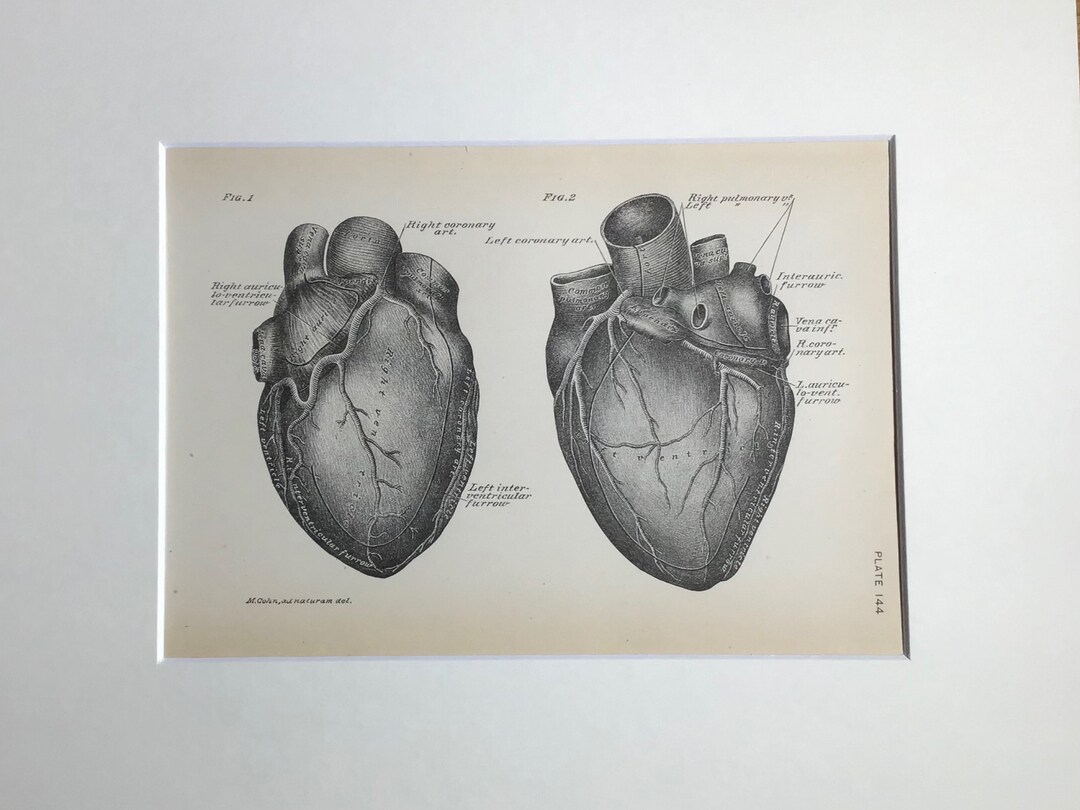 Anatomy Print, 1888 NYC, Autopsy Print, Antique Print, Dissection Print ...