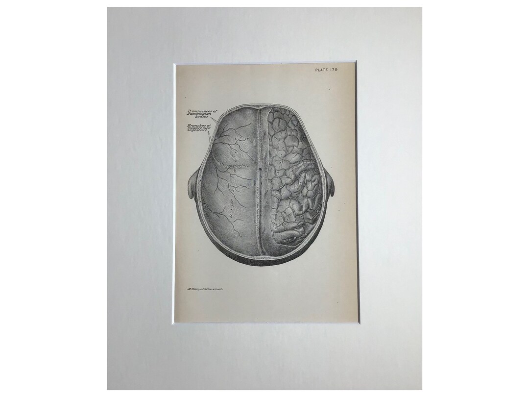 Anatomy Print, 1888 NYC, Autopsy Print, Antique Print, Dissection Print ...