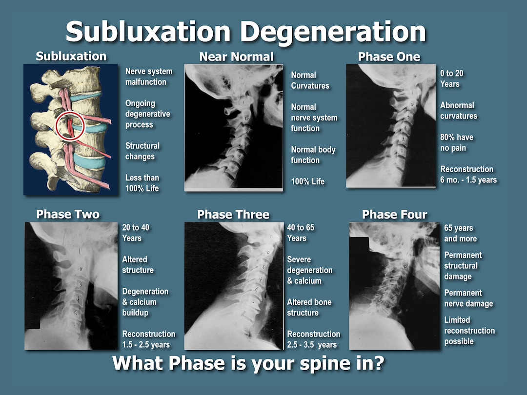 Chiropractic Subluxation Degeneration Poster, Chiropractic Wall Art ...