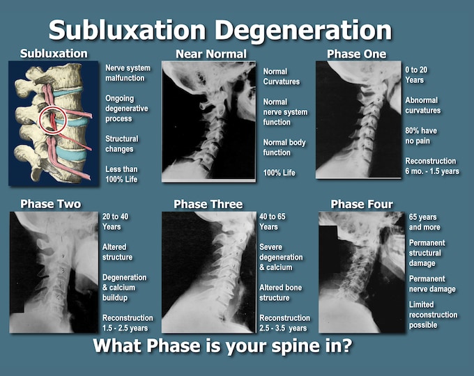 Vertebral Subluxation Complex Chiropractic Poster | Watercolor ...