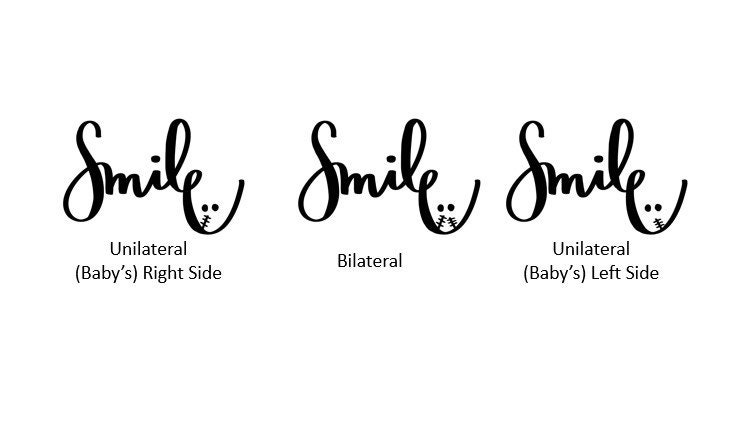 Cleft Lip Onesie, Forever Smile, Cleft Lip Bodysuit, Cleft Lip, Cleft ...