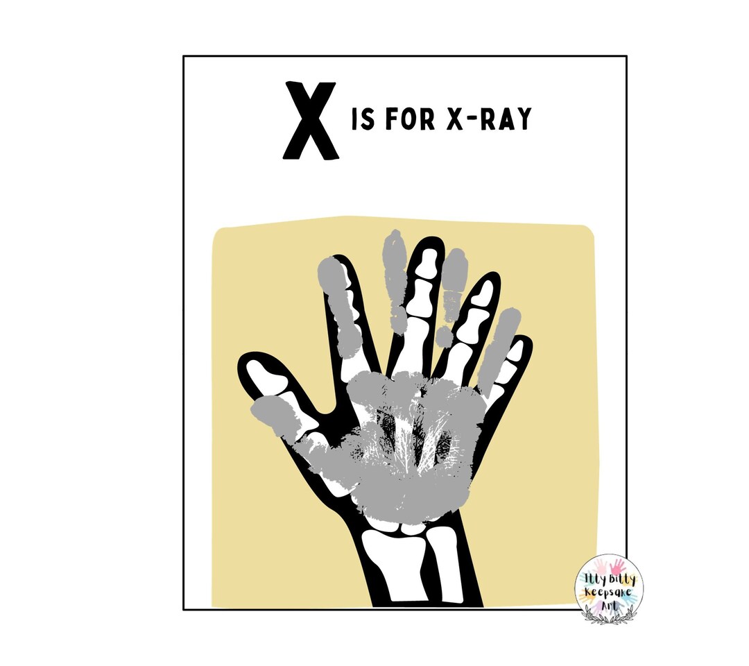 X is for X-ray Handprint Art Template: Letter X Craft (digital Download ...