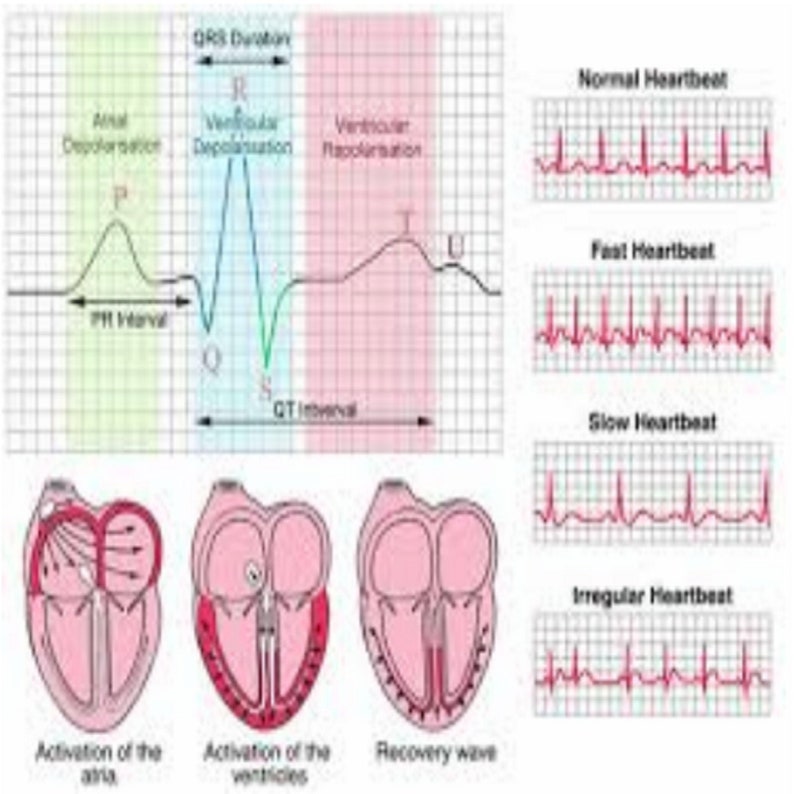 EKG/ECG Interpretation basic and Advanced Strips : Easy and - Etsy