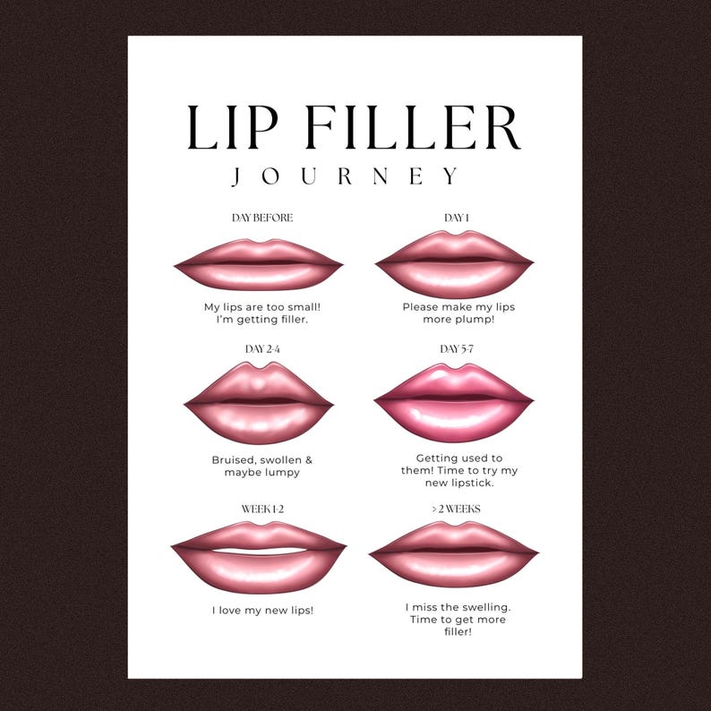 Lip Filler Journey Poster | Lip Injections | Wall Decor | Aesthetics ...