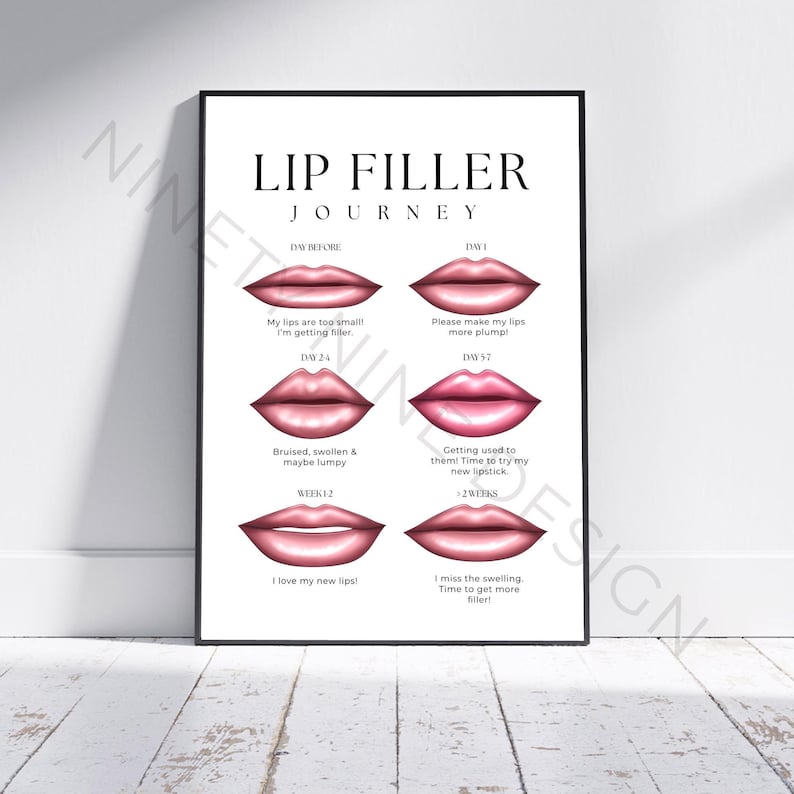Lip Filler Journey Poster | Lip Injections | Wall Decor | Aesthetics ...
