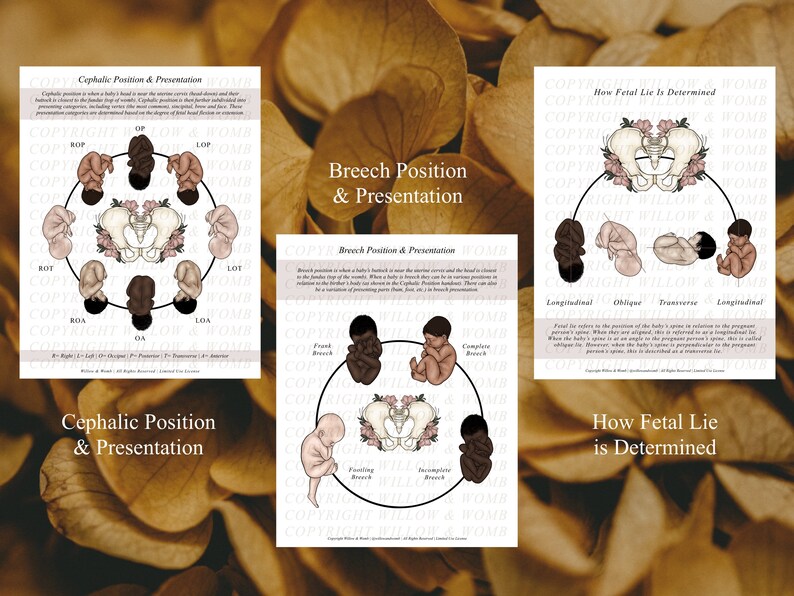 Fetal Position 3 Pack INSTANT DOWNLOAD Professional Handouts - Etsy