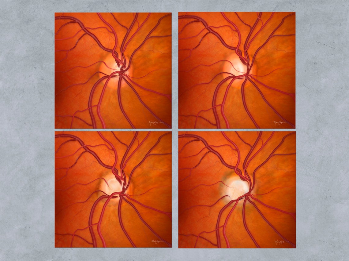 Glaucoma Doctor Gift Optic Nerve Cupping Illustrations Art | Etsy