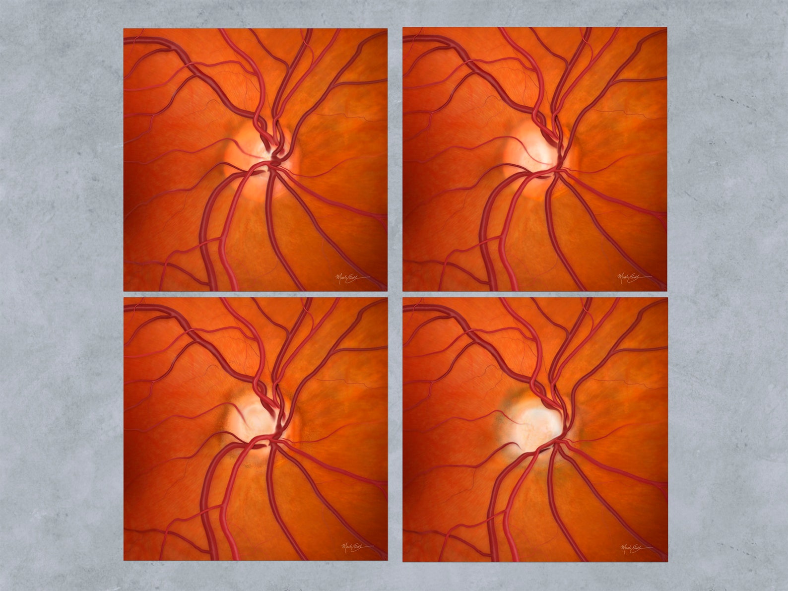 Glaucoma Doctor Gift, Optic Nerve Cupping Illustrations Glaucoma Art ...