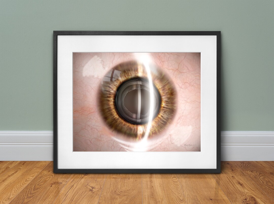 YAG Laser Capsulotomy Illustration Fine Art Print Showing Post ...