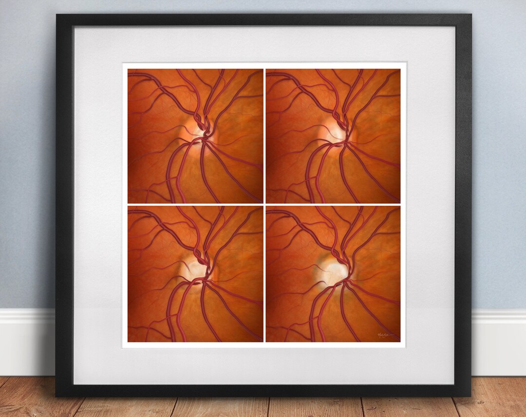 Optic Nerve Cupping Progression Illustration Art Print - Etsy