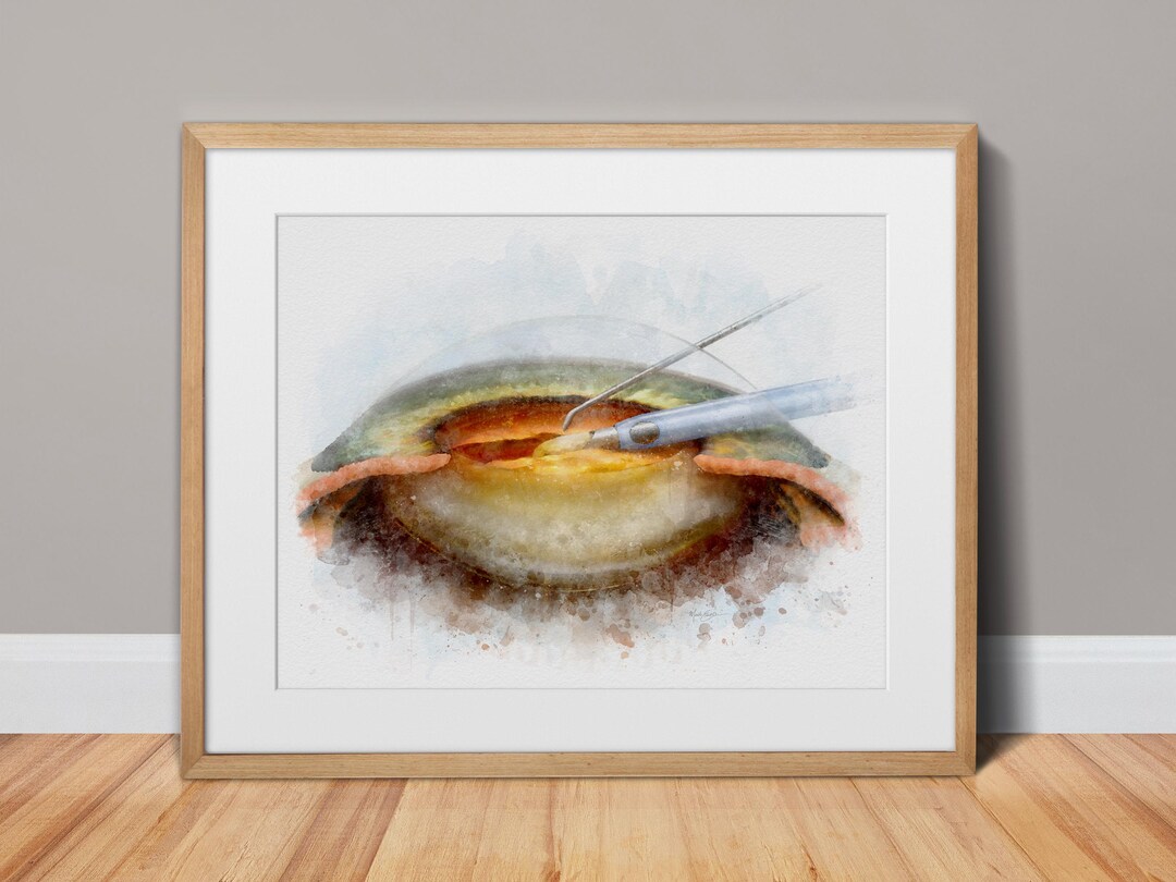Phacoemulsification Cataract Surgery Wall Art Print, Watercolor-style ...