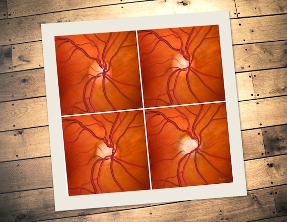 Optic Nerve Cupping Progression Moran CORE | Glaucomatous Cupping