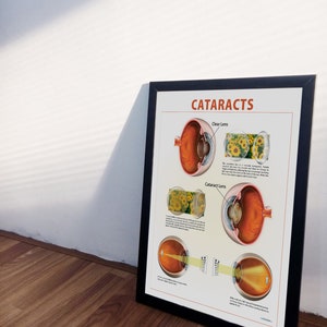 Cataract Poster DIGITAL DOWNLOAD. Eye Doctor Exam Room Instant ...