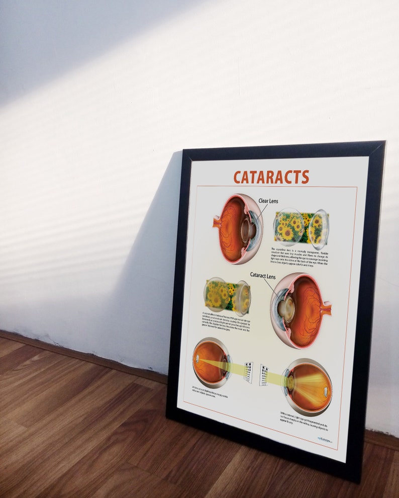 Cataract Poster DIGITAL DOWNLOAD. Eye Doctor Exam Room Instant ...