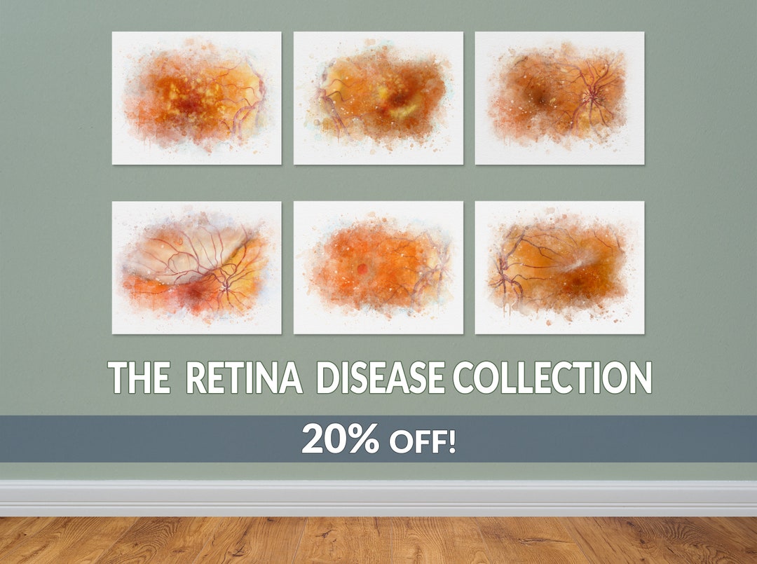Retina Disease Art Prints - the Retina Disease Collection - 6 Eye ...