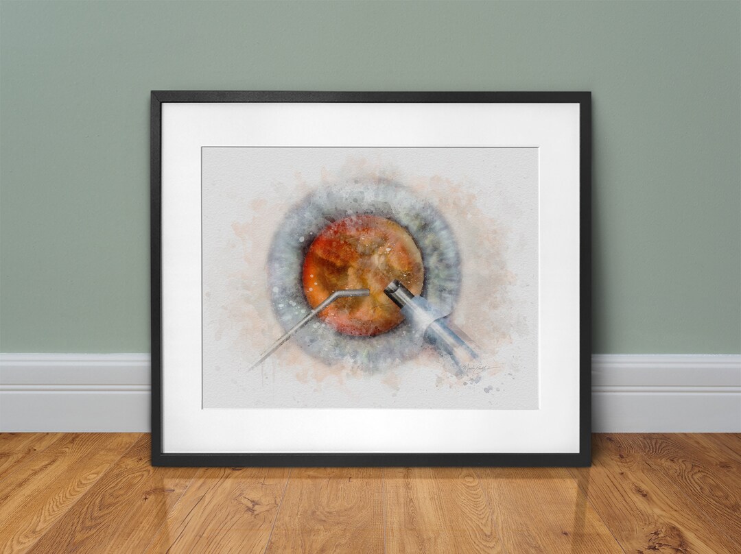 Cataract Surgery Art Print Watercolor Style Phacoemulsification Eye ...
