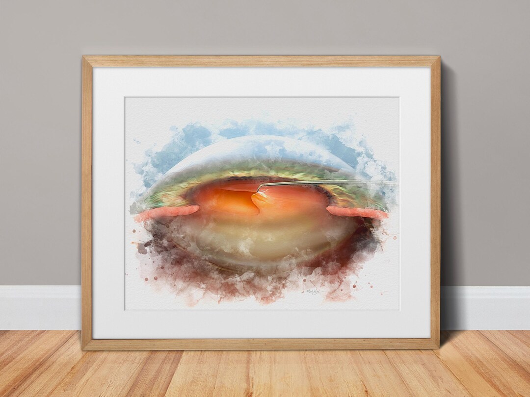 Cataract Surgery Wall Art Print, Watercolor-style Capsulotomy Art, a ...