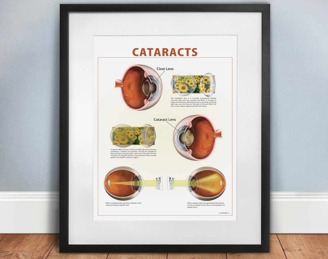 Cataract Poster DIGITAL DOWNLOAD. Eye Doctor Exam Room Instant ...