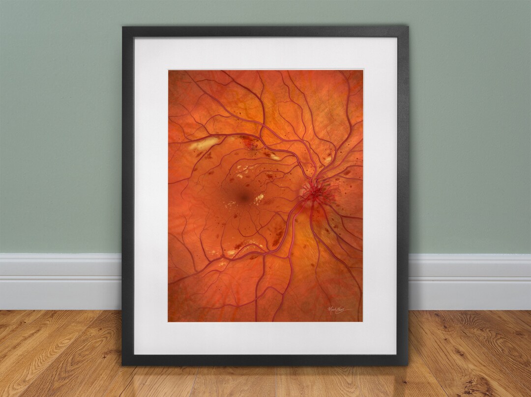 Proliferative Diabetic Retinopathy PDR Art Print for Eye Doctor Decor ...