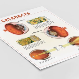 Cataract Poster DIGITAL DOWNLOAD. Eye Doctor Exam Room Instant ...