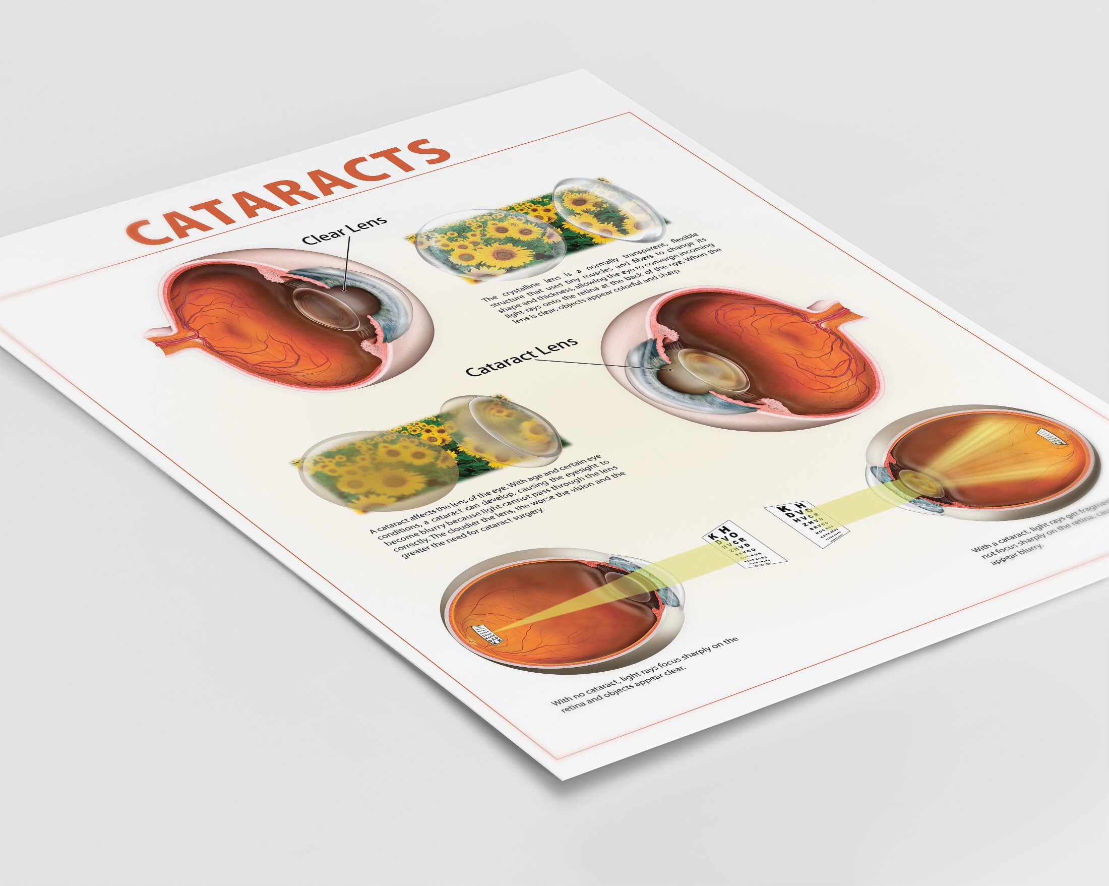 Cataract Poster DIGITAL DOWNLOAD. Eye Doctor Exam Room Instant ...