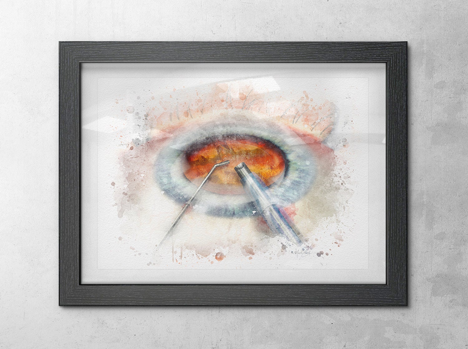 Cataract Surgery Art Print Gift for an Eye Surgeon - Etsy
