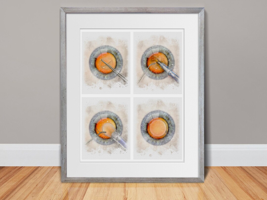 Ophthalmology Wall Art Print Eye Surgeon Decor, Cataract Surgery Series ...